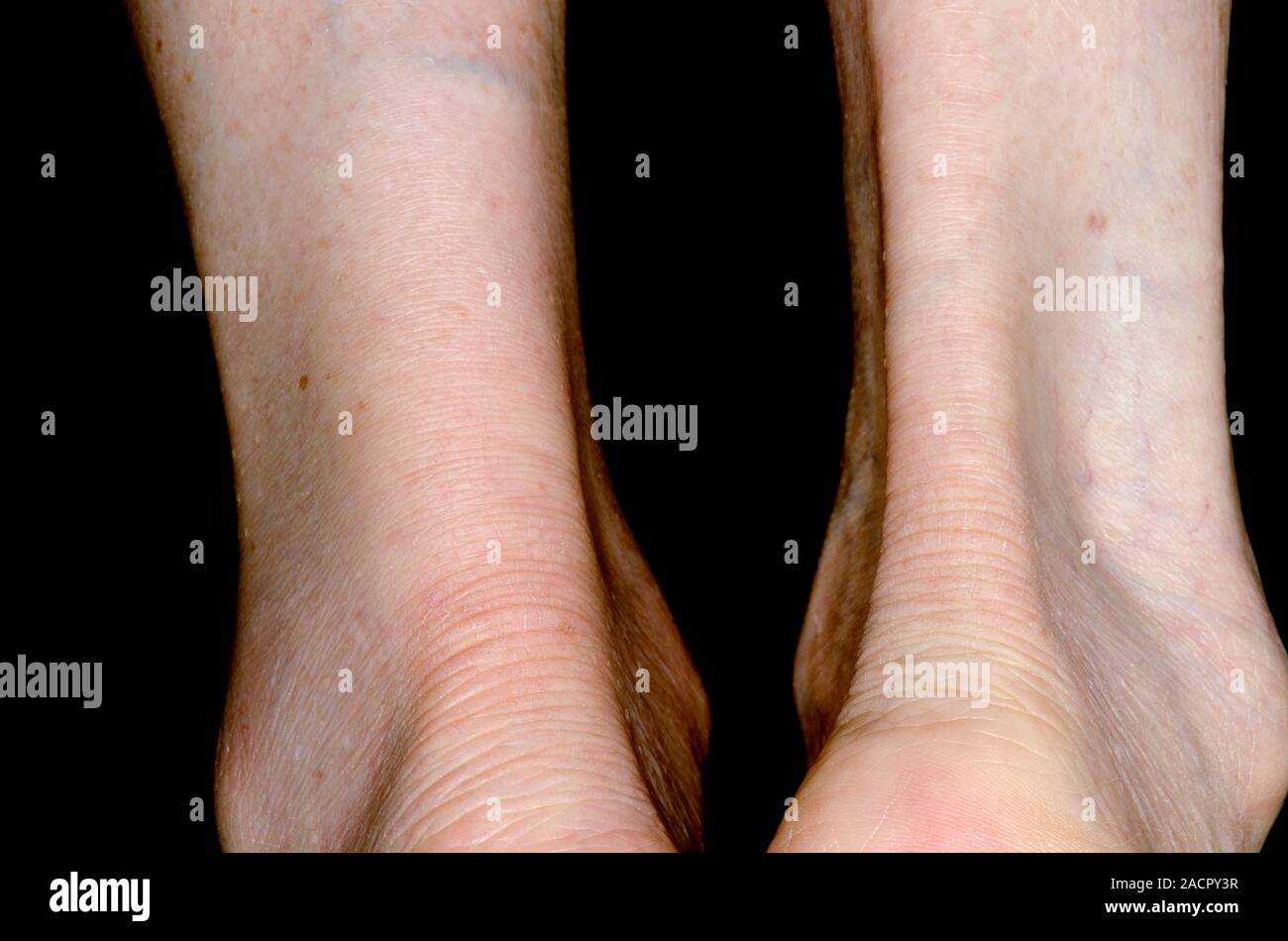Swollen achilles tendon (at left) in the ankle of a 69 year old male ...