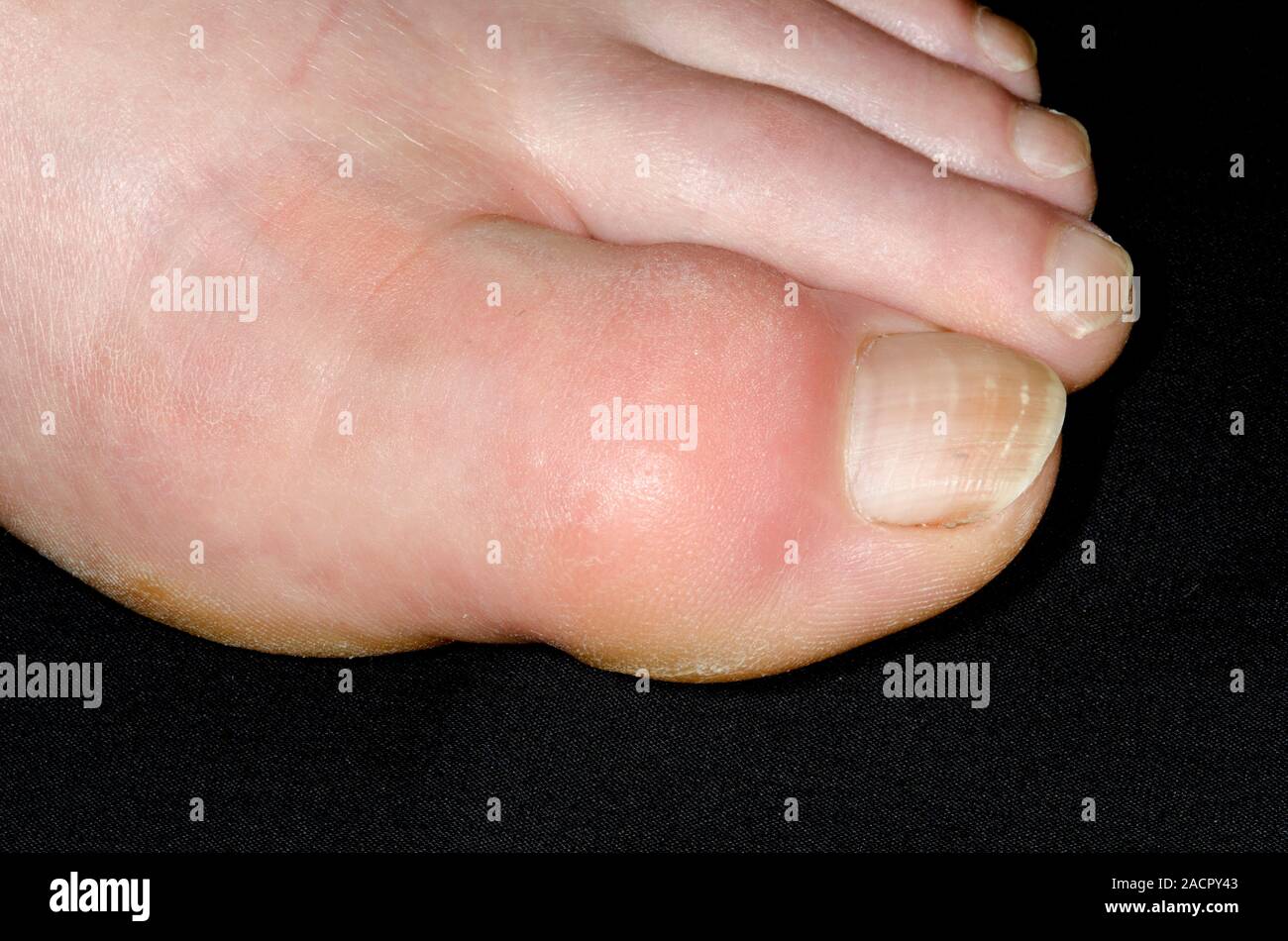 Close-up of a swelling (tophus) in the toe of a 67 year old male ...