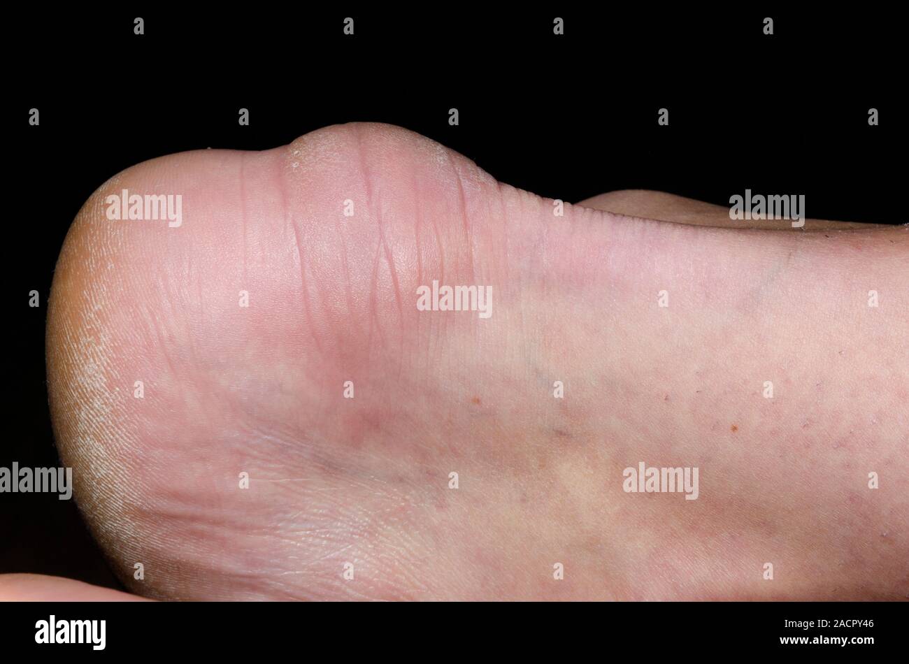 Bump on the heel of the foot of a 21 year old male patient, known as ...