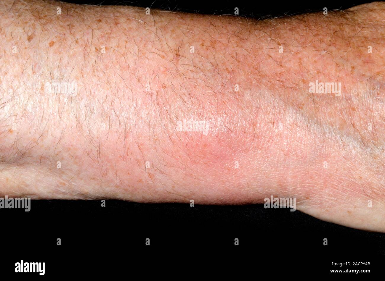 Red swelling (tophus) in the wrist of a 74 year old male patient with ...