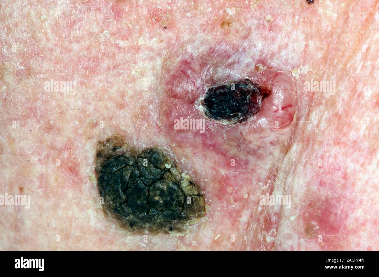 Close Up Of A Basal Cell Carcinoma Bcc At Top Or Rodent Ulcer