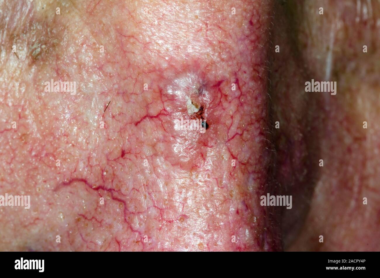 Close-up of a basal cell carcinoma (BCC), or rodent ulcer, on the nose ...
