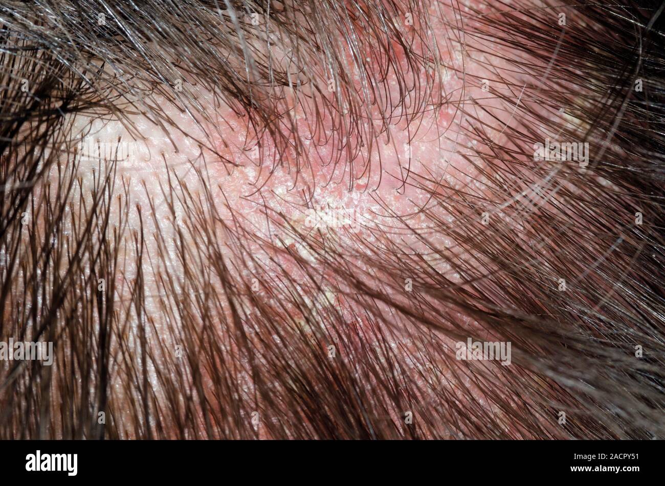 Red flaky patches of skin on the scalp of a 46 year old male patient ...