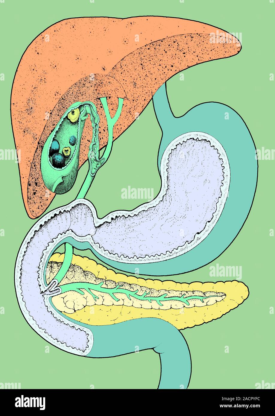 Gallstones. Cutaway computer artwork showing gallstones (small, round ...