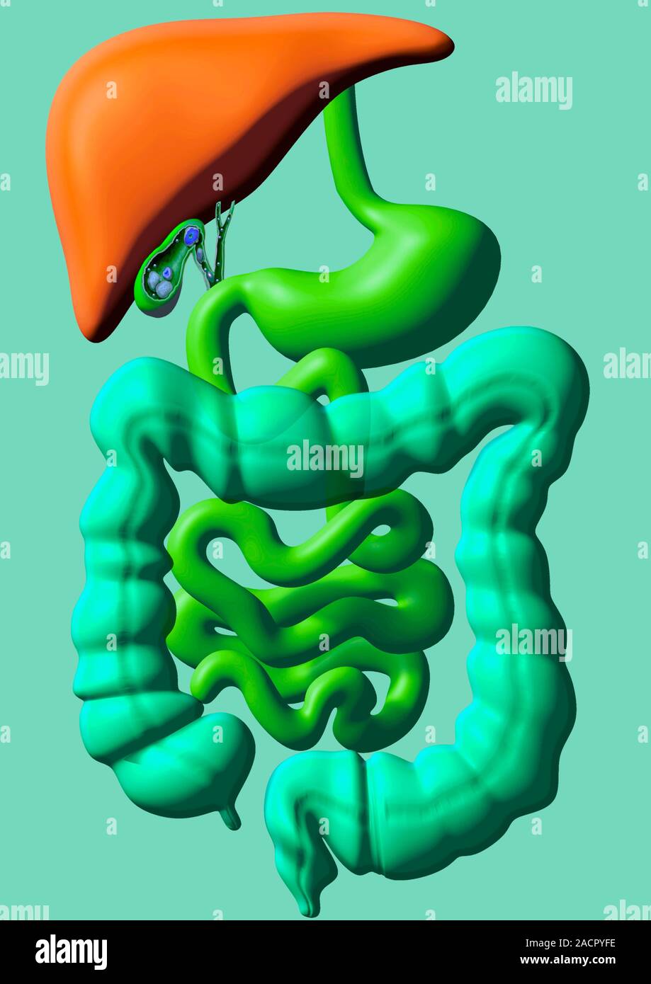 Gallstones. Cutaway computer artwork showing gallstones (blue, round ...