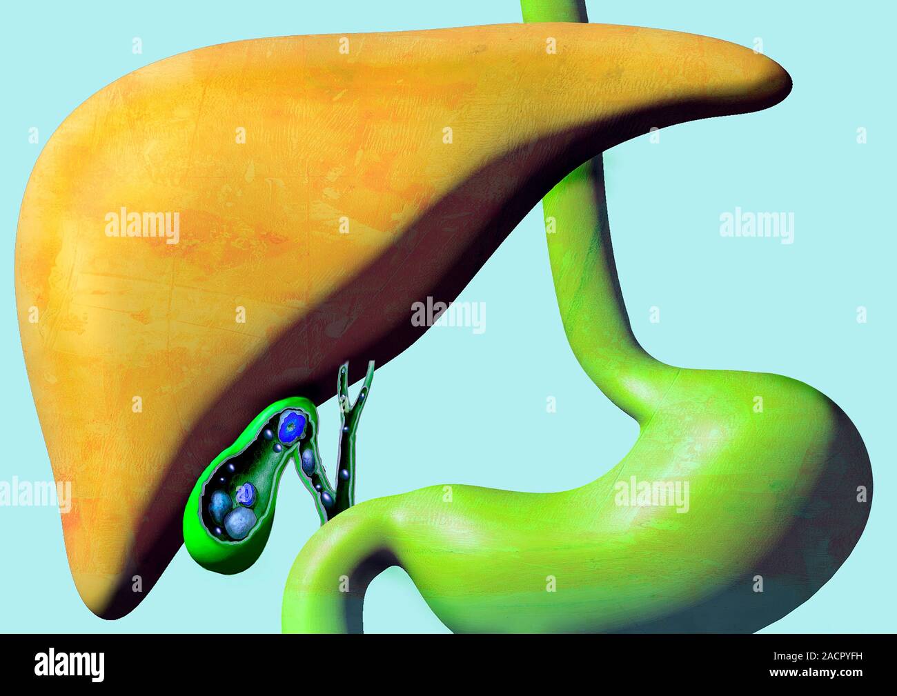 Gallstones. Cutaway computer artwork showing gallstones (blue, round ...
