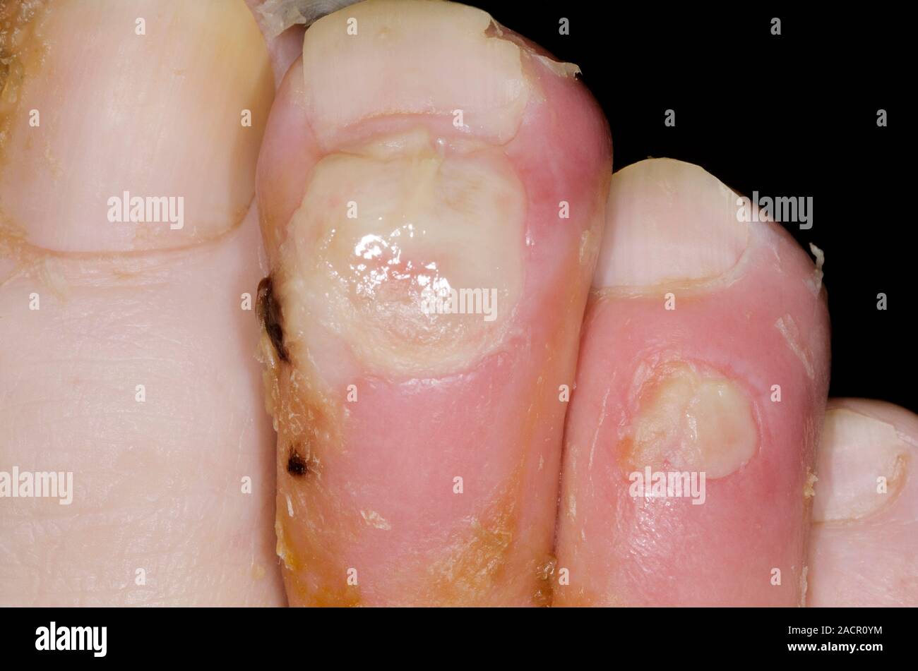 Close-up of two infected toes with neuropathy in a 73 year old male ...