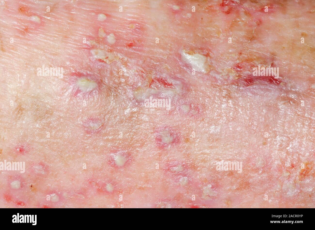 Close-up of infected eczema on the skin of a 69 year old female patient ...