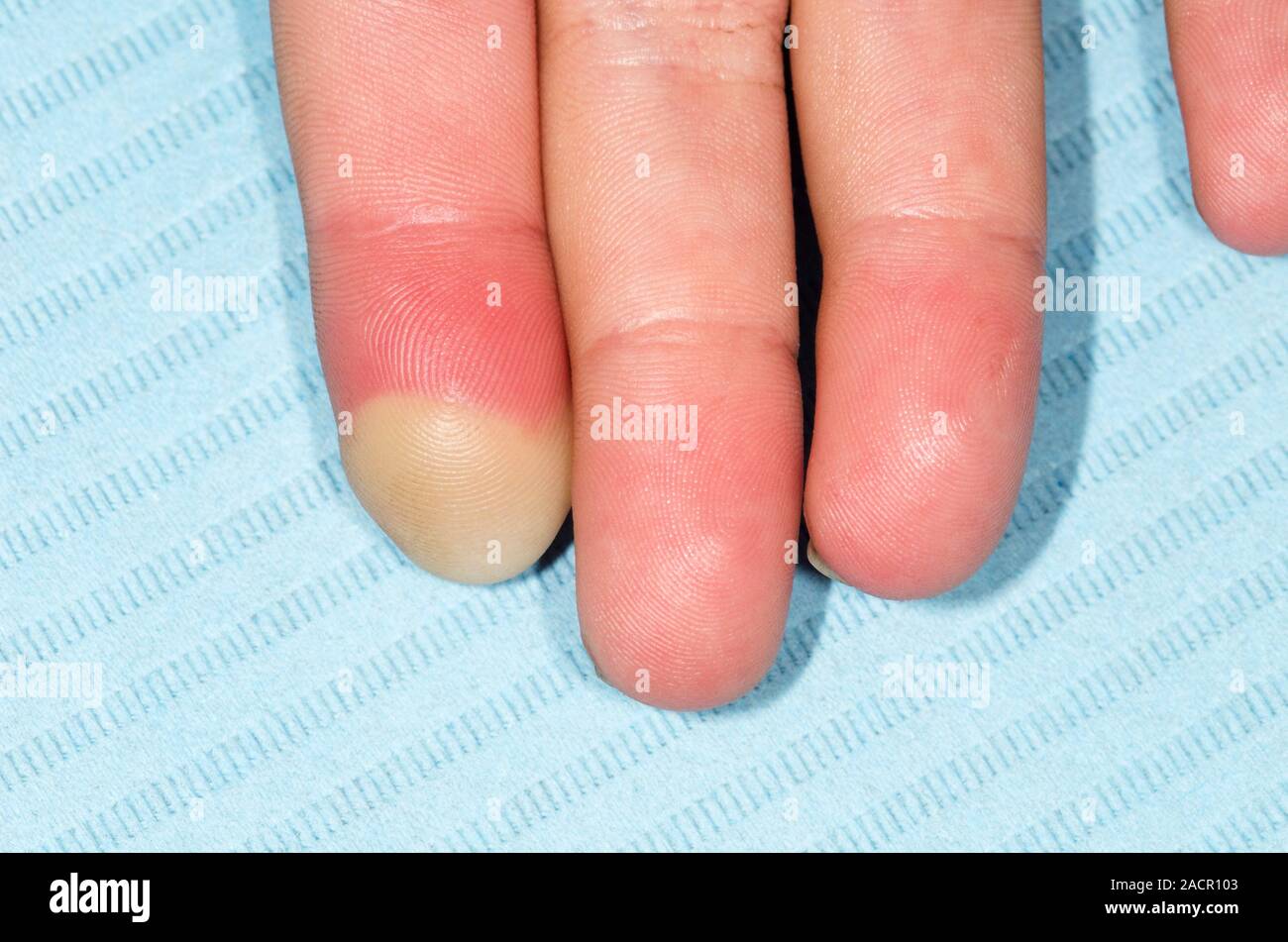 Close-up of pus under the skin on the tip of the finger due to an ...