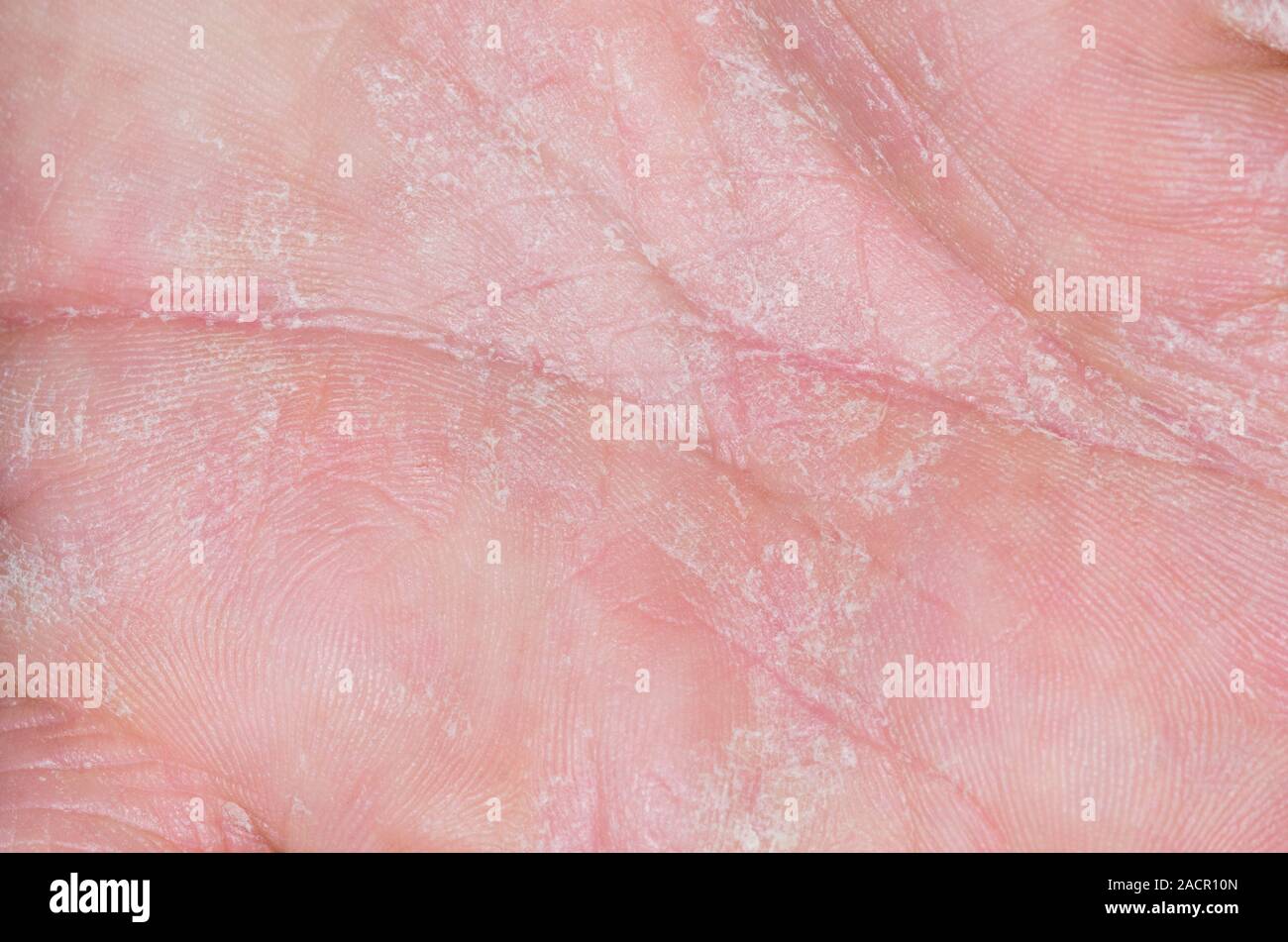 Close-up of scaly skin on the palm of the hand of a 41 year old male ...