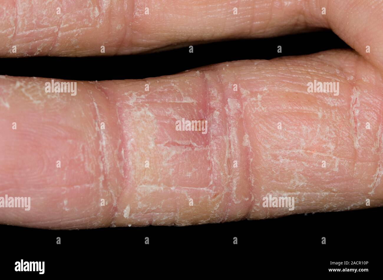 Close-up of cracked and scaly skin on the fingers of the hand of a 41 ...