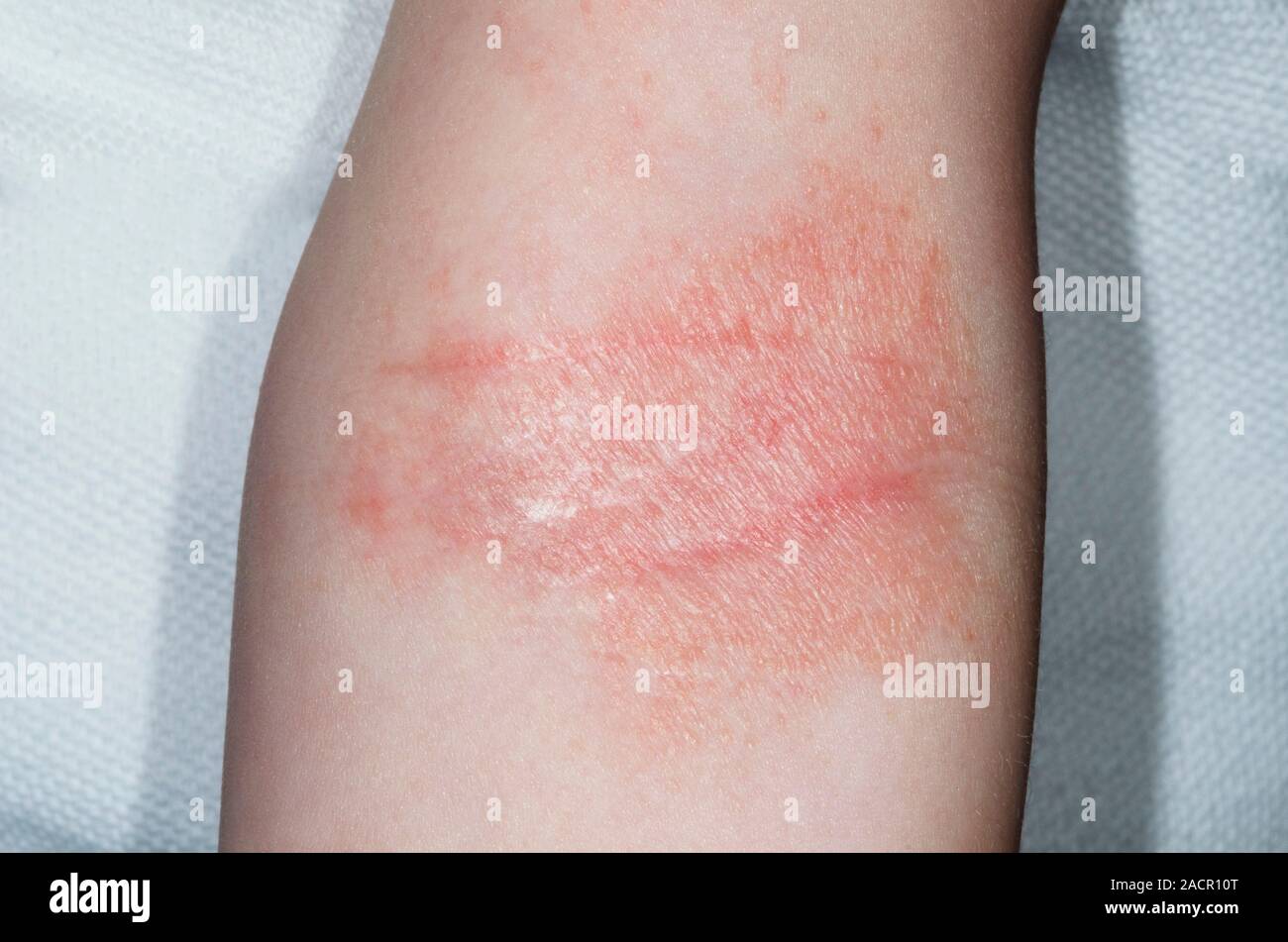 Red and inflamed skin behind the elbow in a 2 year old male patient ...