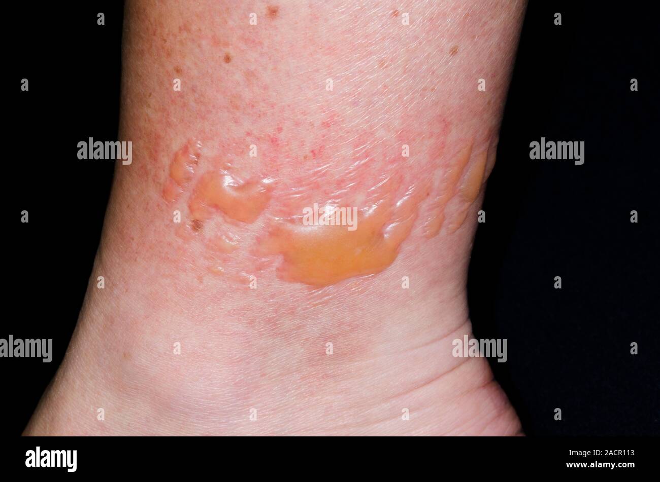 Blistered skin around the ankle of the foot of a 45 year old female ...