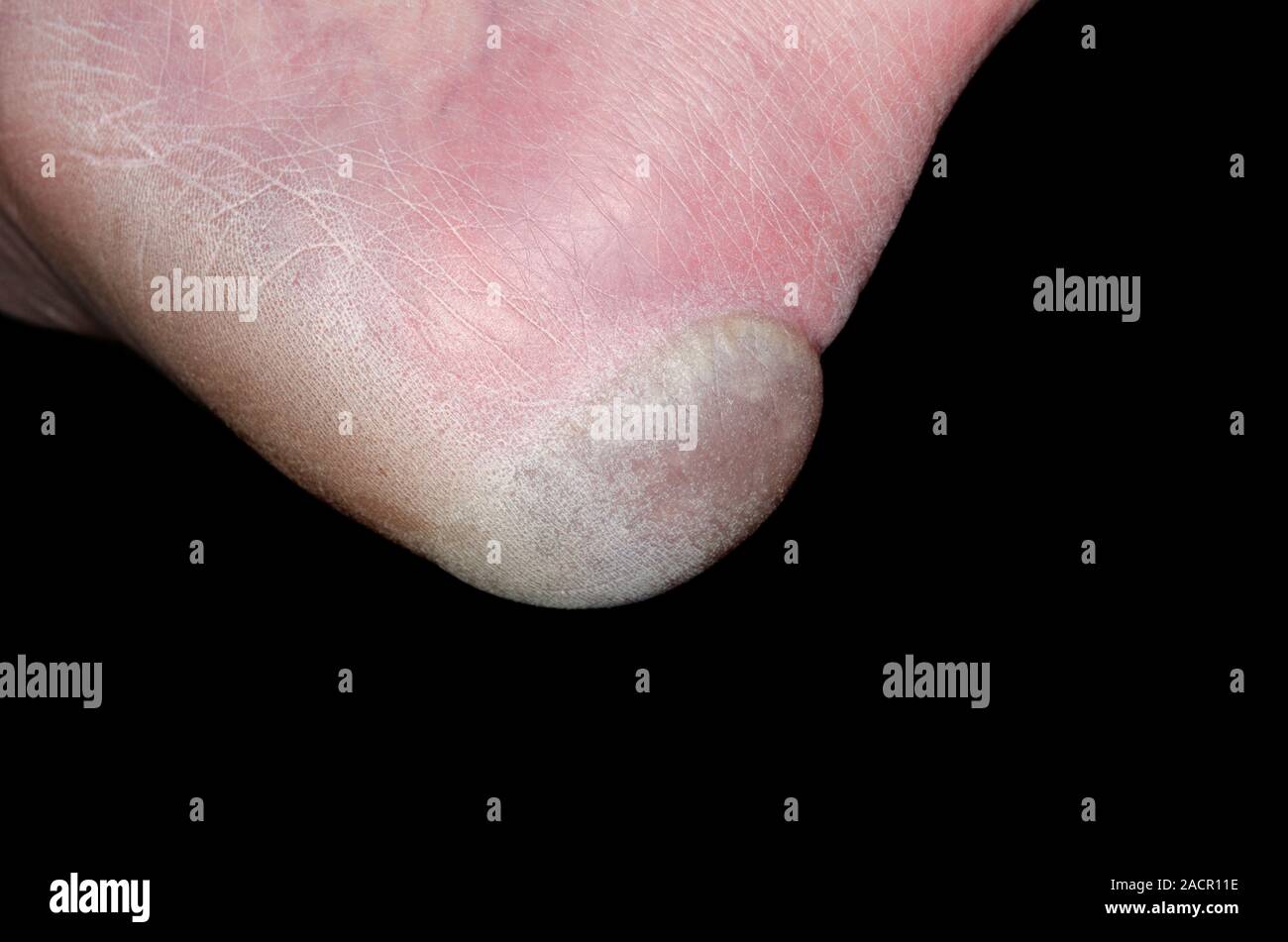 Discoloured heel of an ischaemic foot of a 79 year old male patient one ...