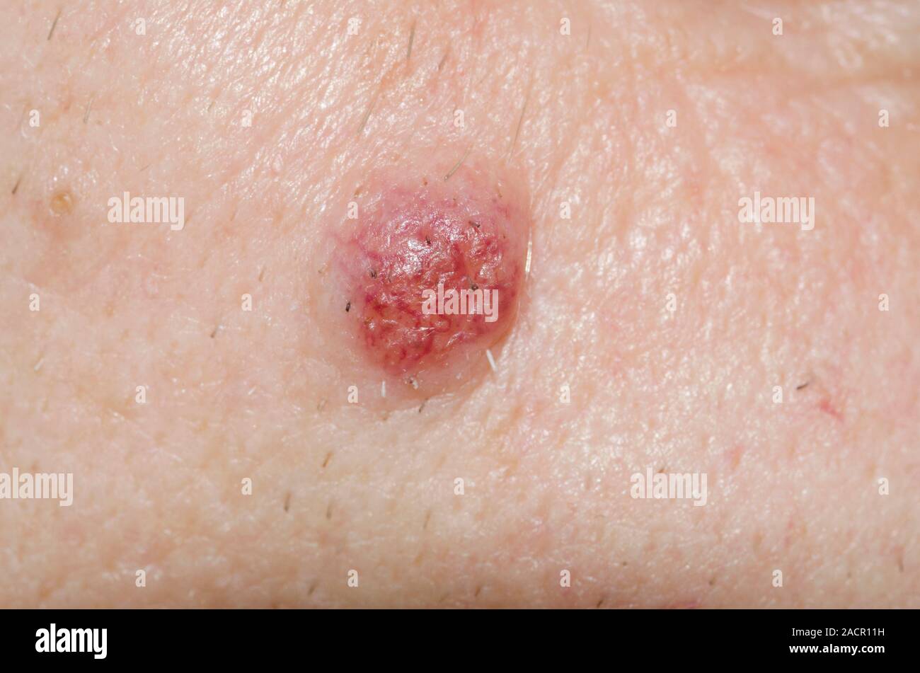 Close-up of an intradermal naevus (mole) on the skin of a 63 year old ...