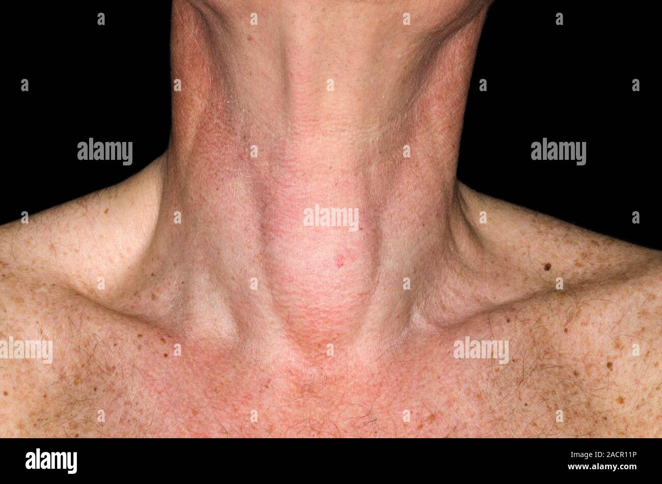 Cystic nodule (lump) on the thyroid gland in the neck of a 63 year old ...