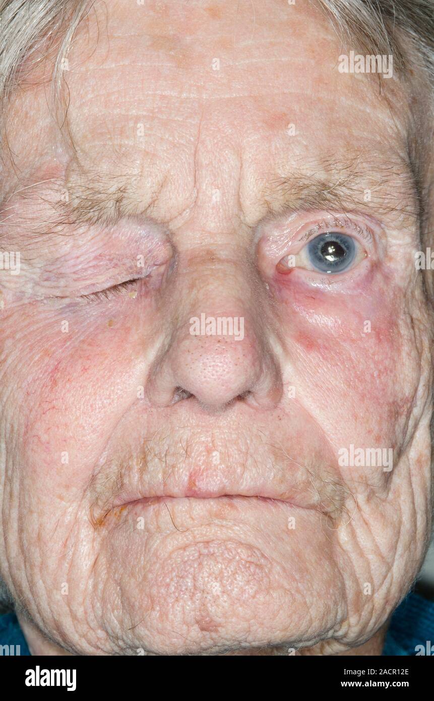 One-sided (unilateral) paralysis of the face in an 89 year old female ...
