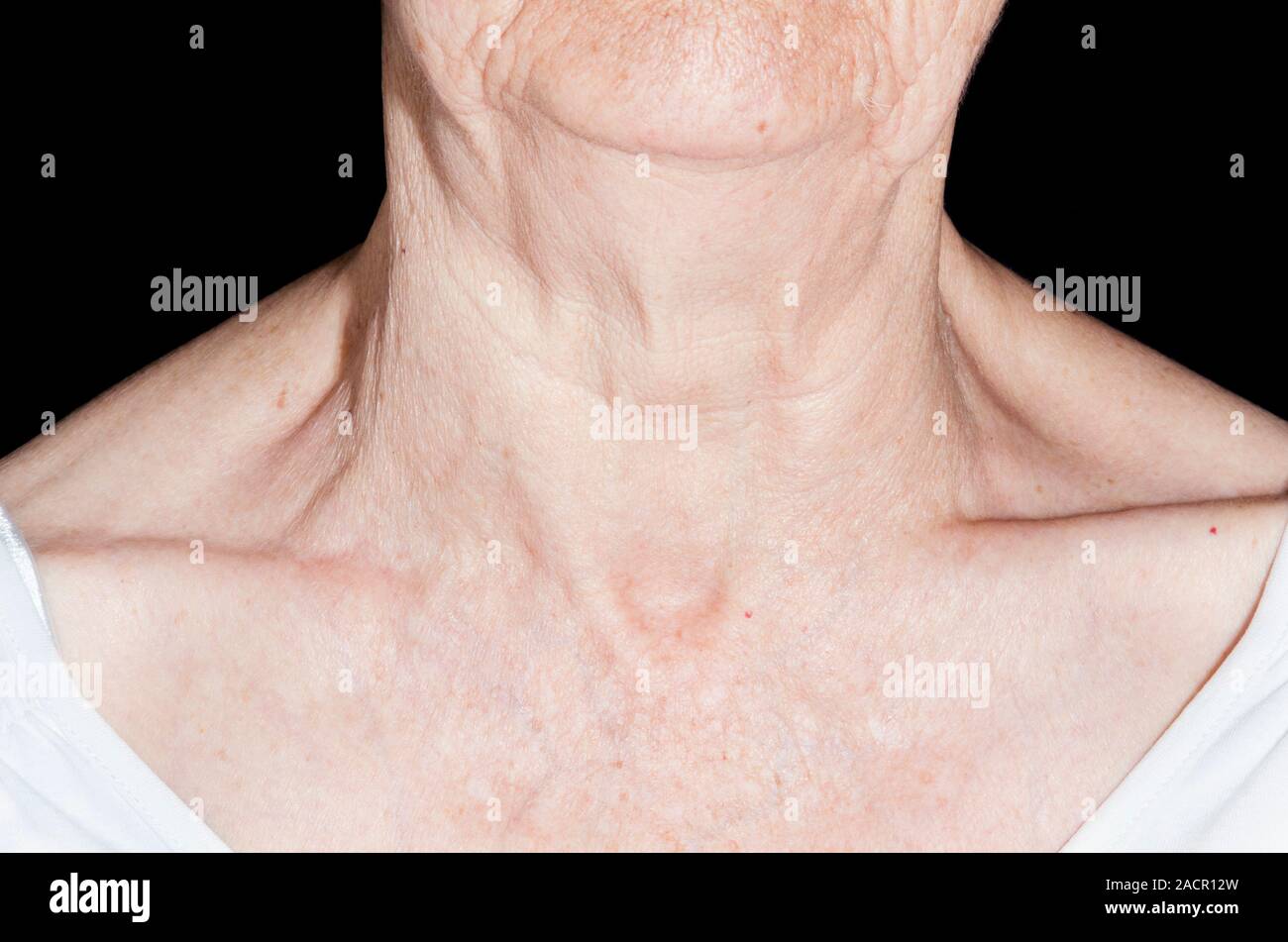 Swollen thyroid gland in the neck of a 76 year old female patient with ...