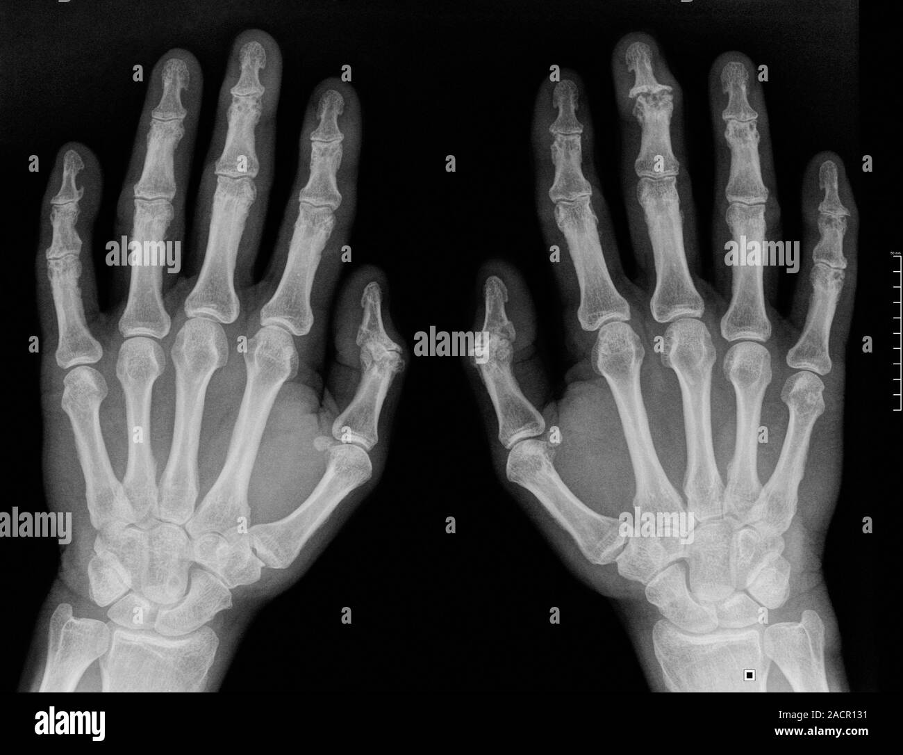 X-ray of the hands of a 55 year old male patient with osteoarthritis ...