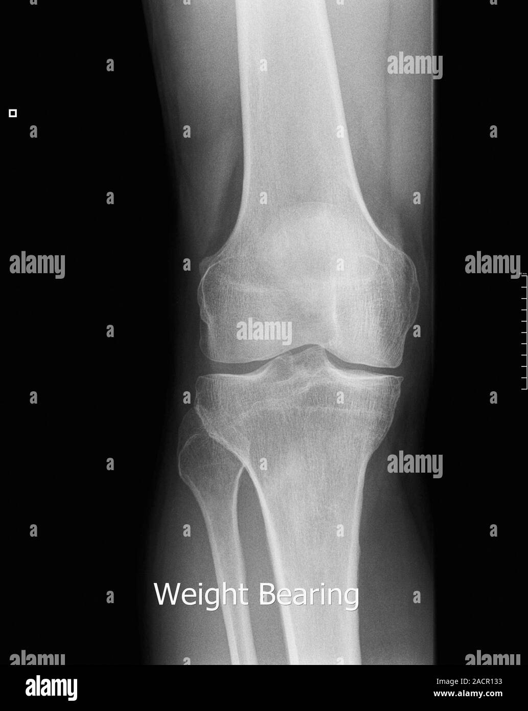 X-ray of the joint of the knee of a 55 year old male patient with early ...