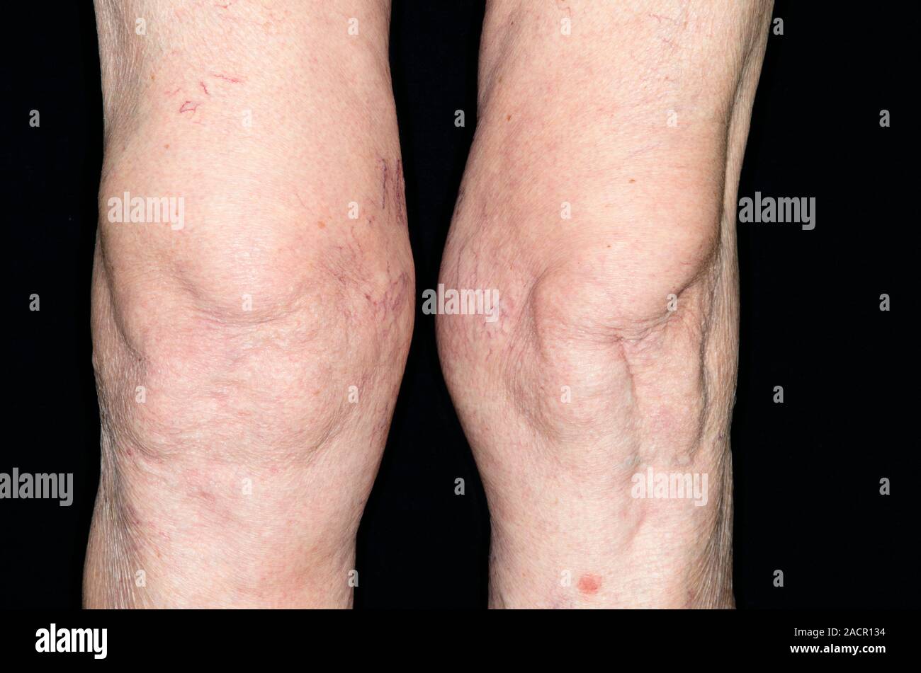 Inflamed knee (at left) of a 76 year old female patient due to effusion ...
