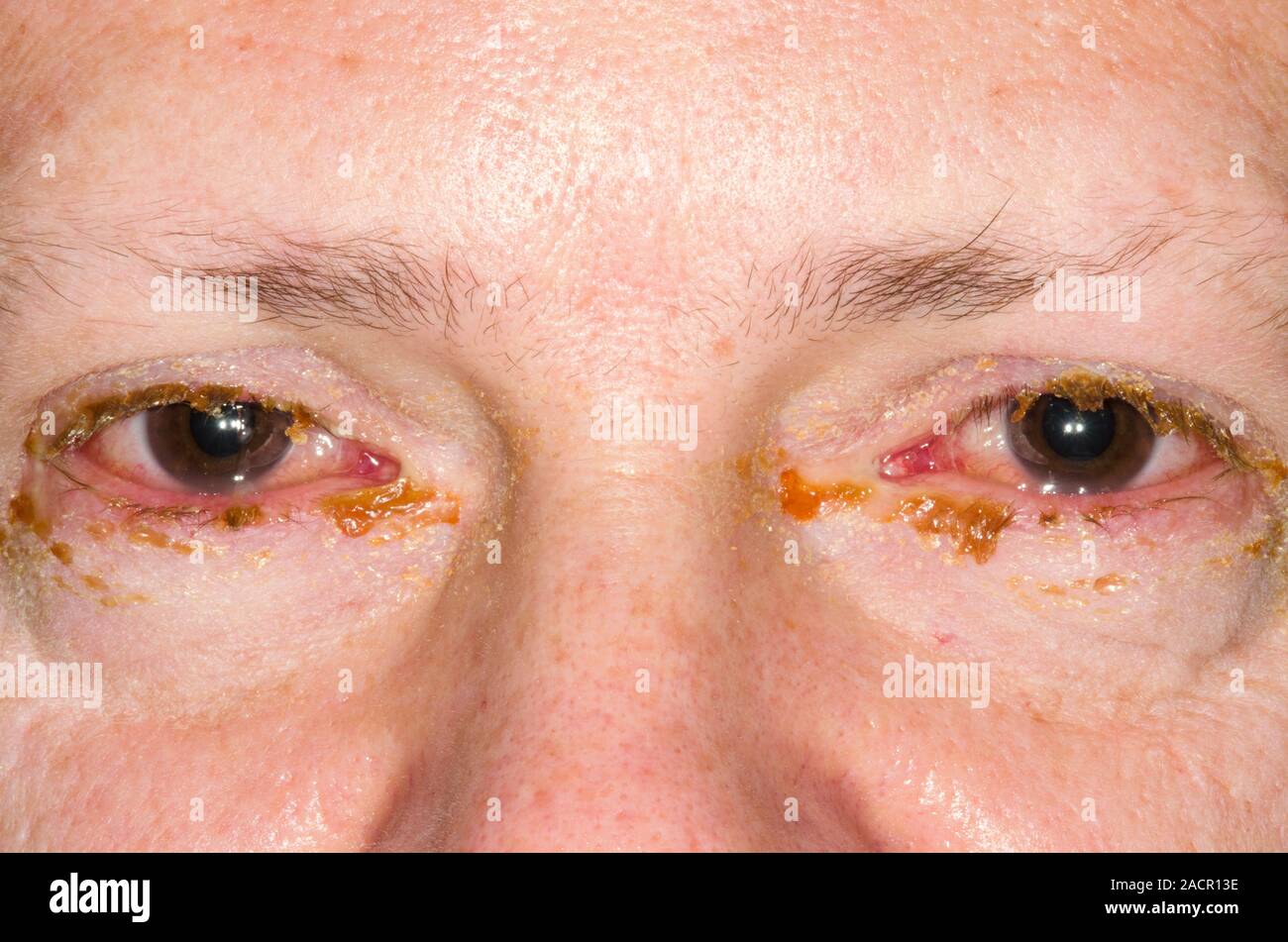 Red and encrusted eyes of a 53 year old male patient with viral ...