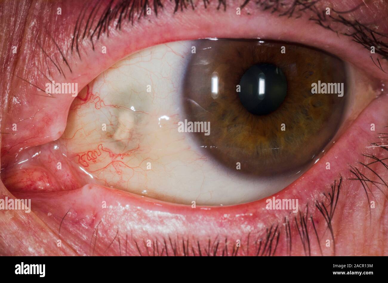 Close-up of the white of the eye (sclera) of a 69 year old male patient ...