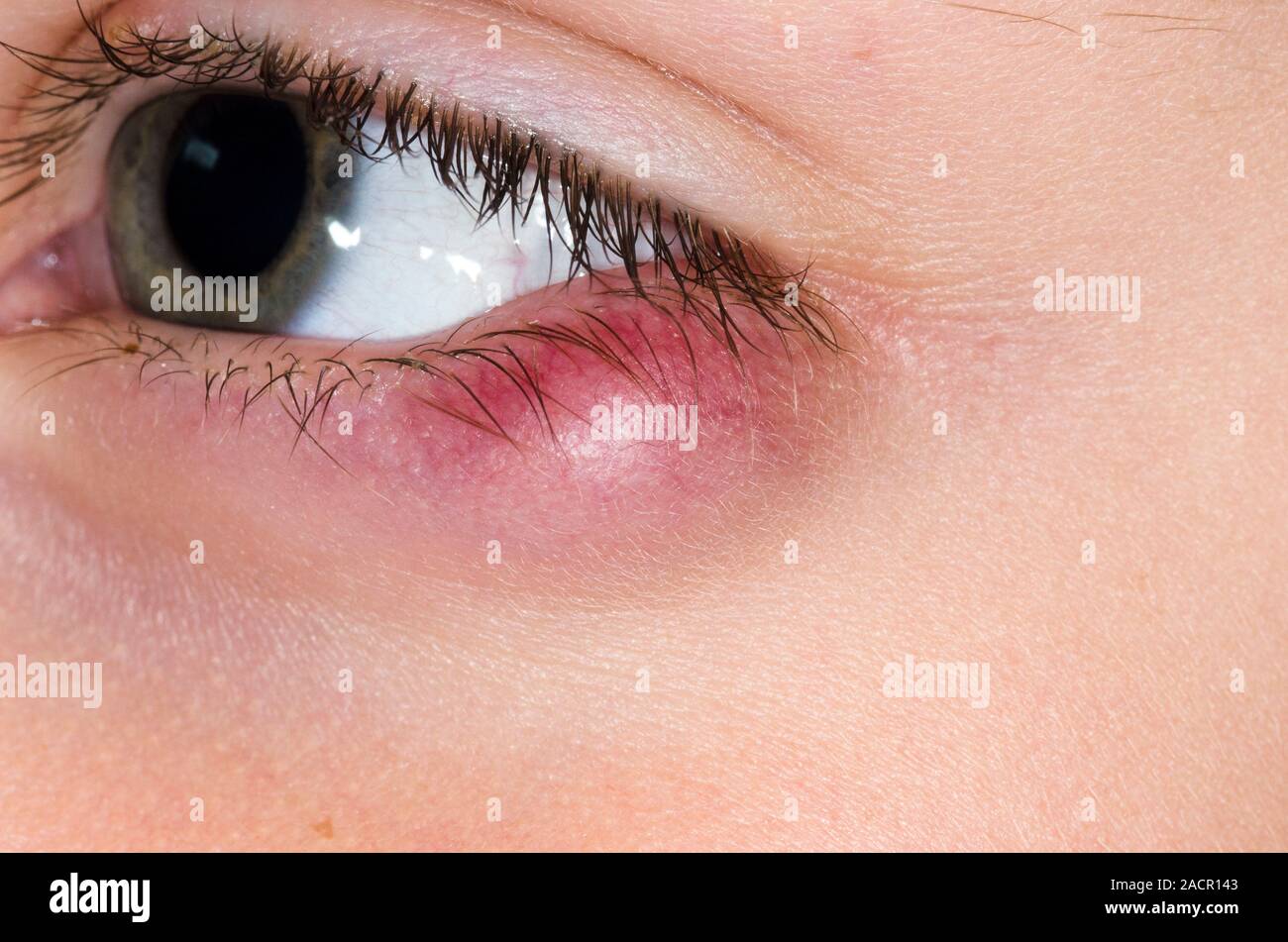 Close-up of a red and inflamed meibomian cyst (chalazion) in the lower ...