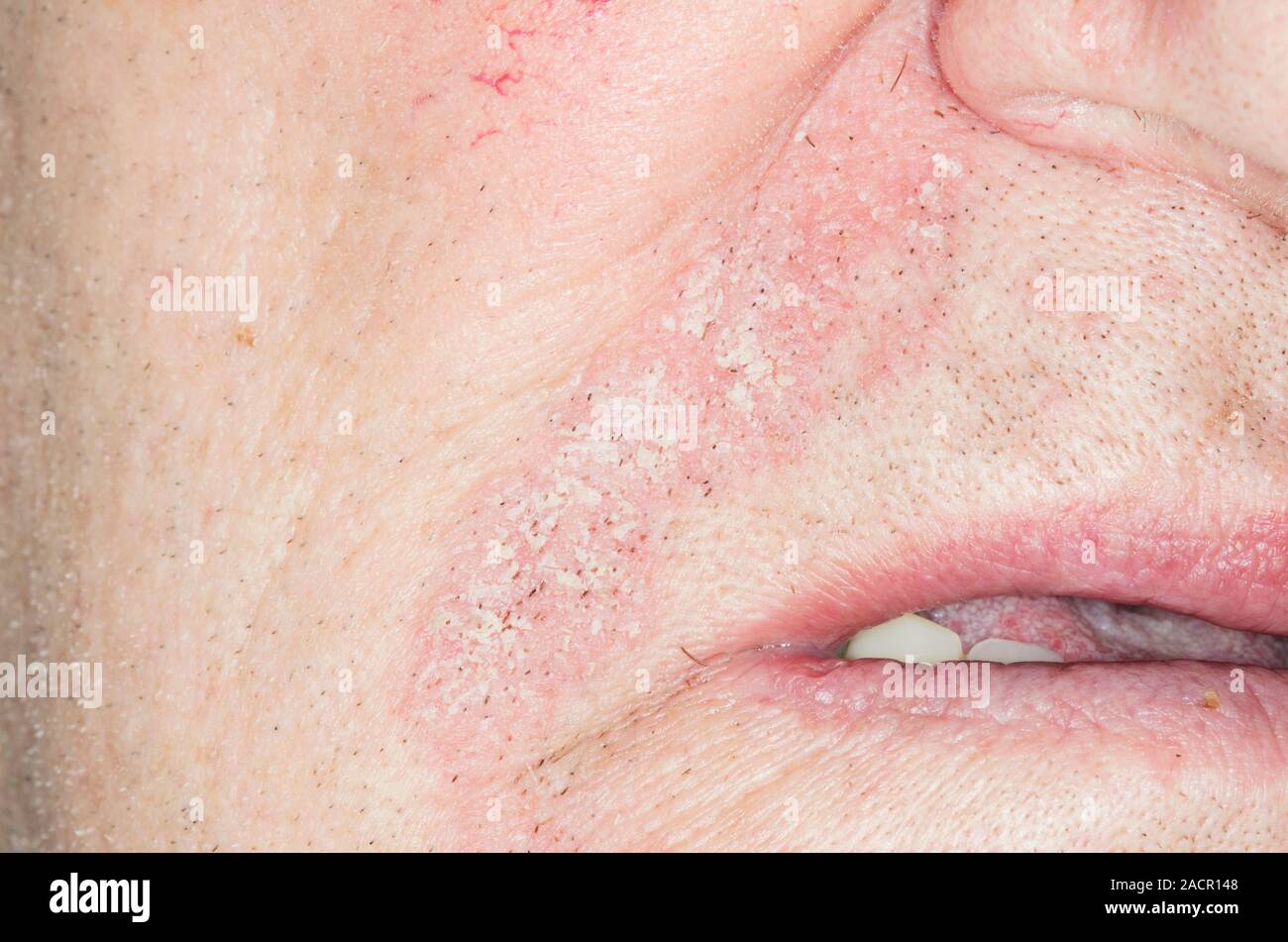 Close-up of a red and scaly patch of skin in the naso-labial fold on ...