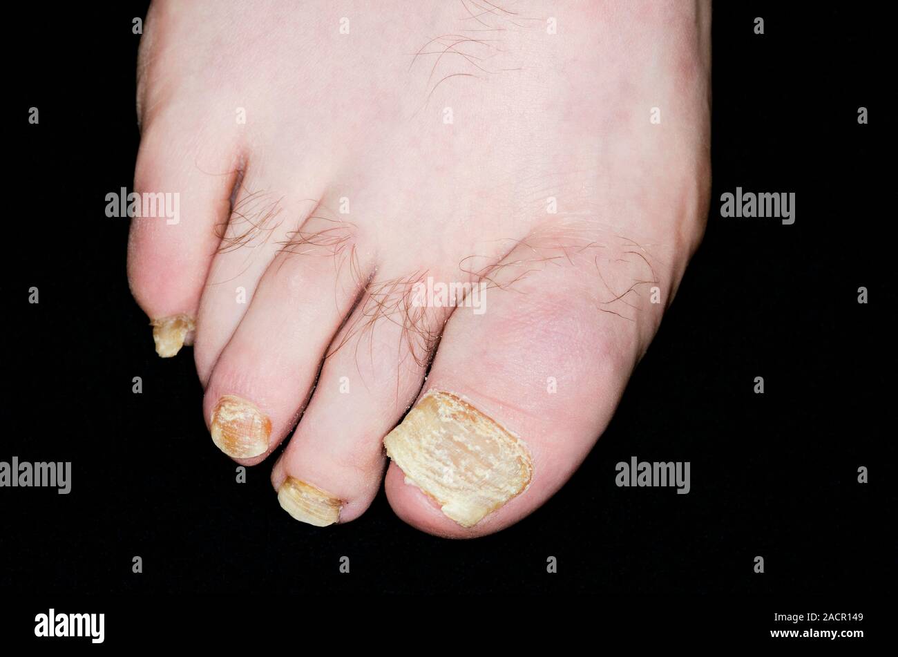 Close-up of thickened and discoloured toenails of a 35 year old male ...