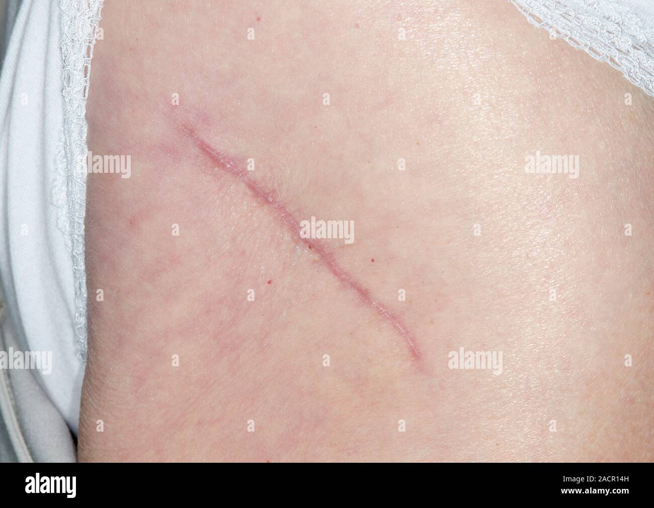 Scar on the upper thigh of a 77 year old female patient following total ...