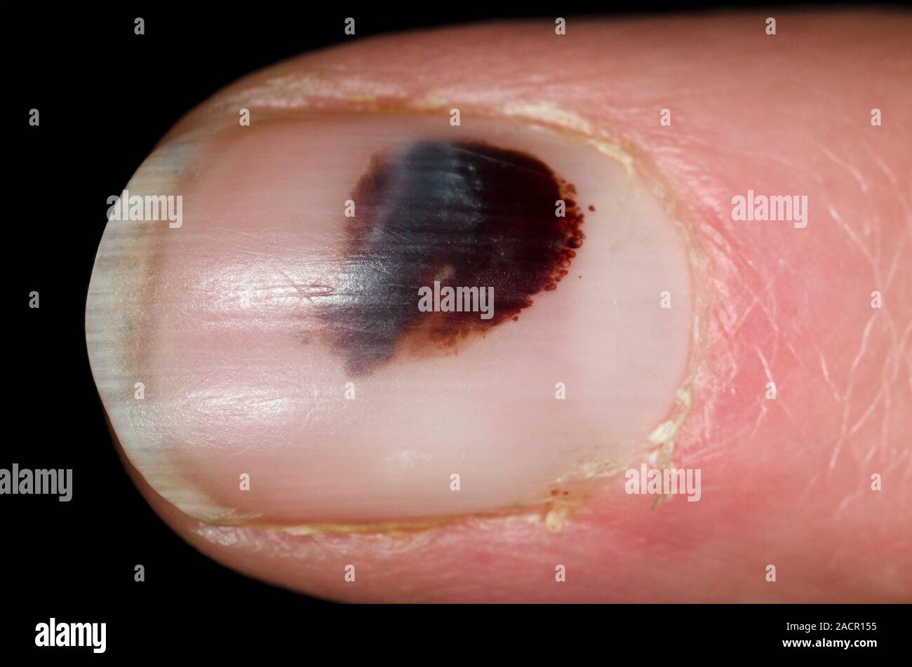 Close-up of a bruise (haematoma) under the fingernail (subungual) of a ...