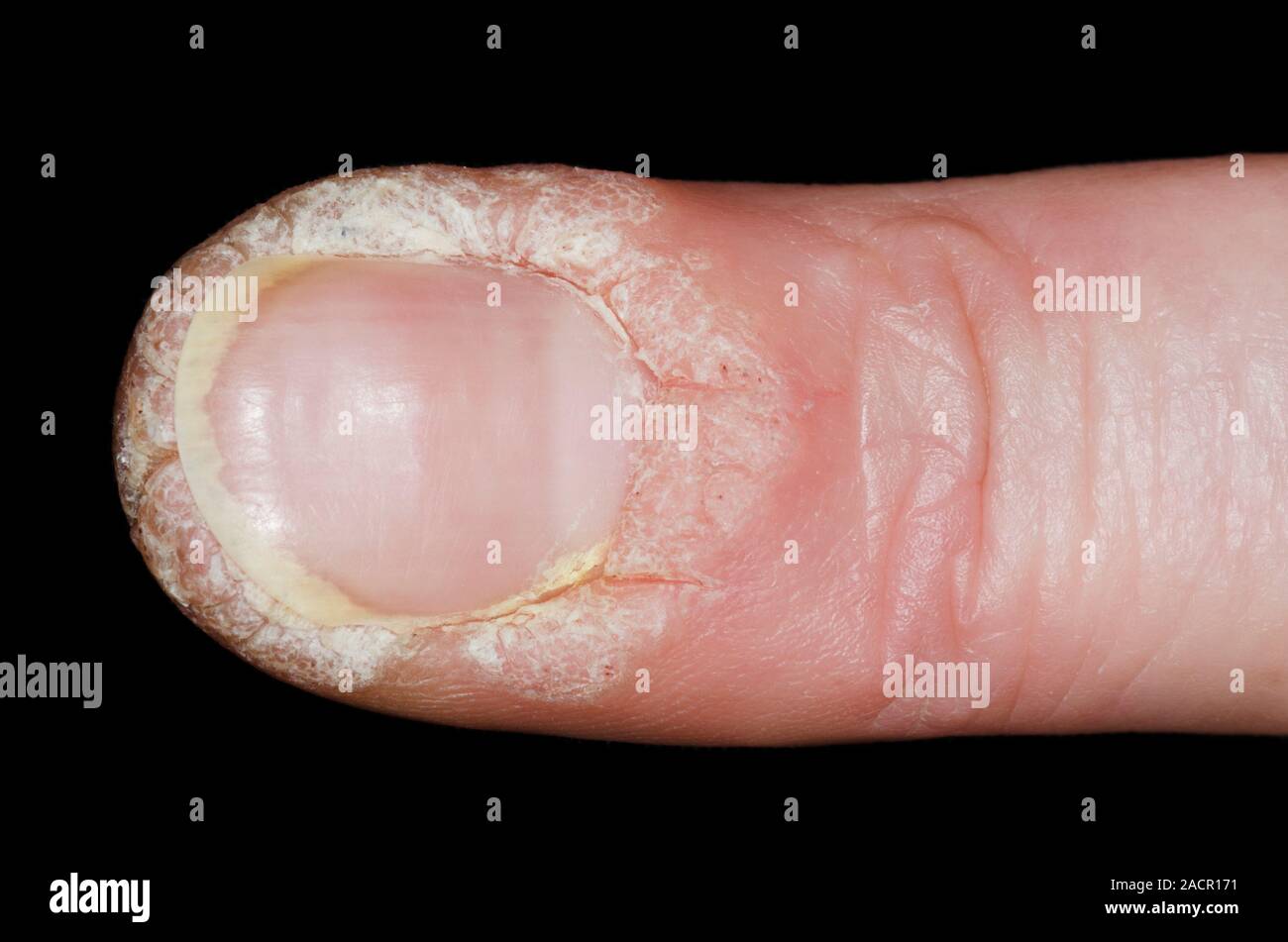 Close-up of warts (verrucas) around the fingernail of a 54 year old ...