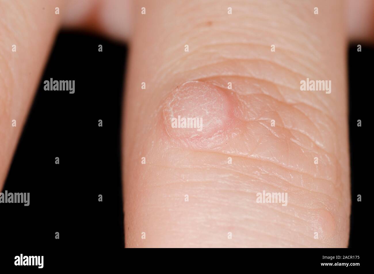 Close-up of a wart (verruca) on the finger of a 54 year old female ...