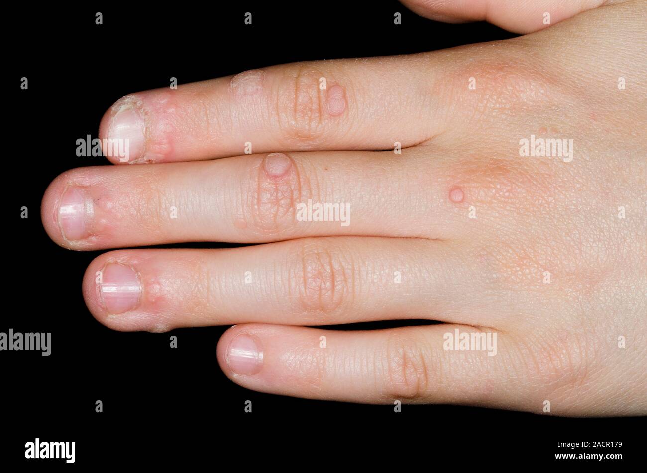 Close-up of warts (verrucas) on the fingers of a 54 year old female ...