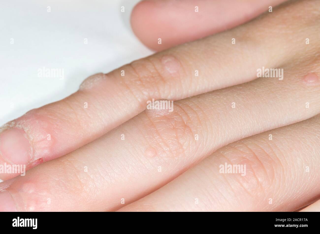 Close-up of warts (verrucas) on the fingers of a 54 year old female ...