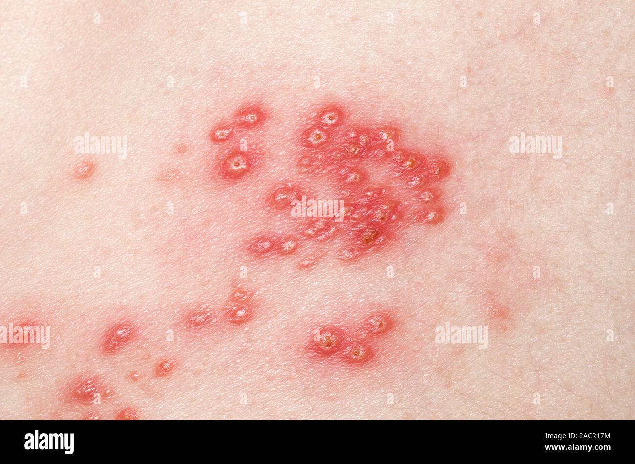 Close-up of a rash of blisters (papules) on the skin of a 2 year old ...