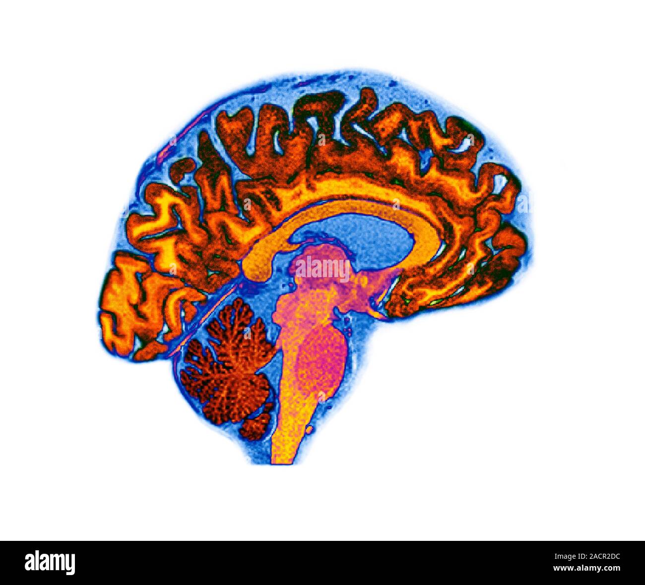 Brain. Coloured magnetic resonance imaging (MRI) scan of a sagittal section through a healthy ...