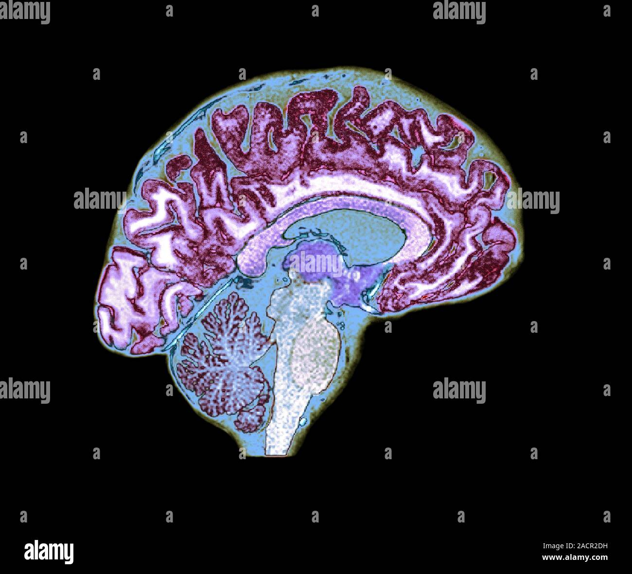 Brain. Coloured magnetic resonance imaging (MRI) scan of a sagittal section through a healthy ...