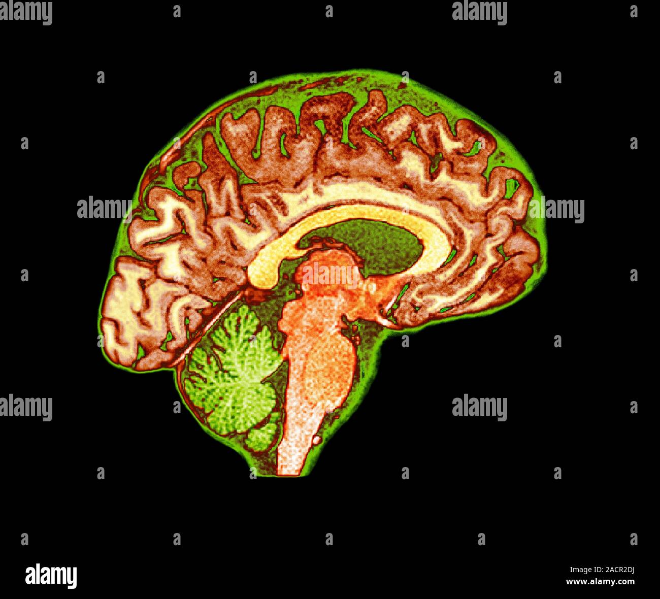 Brain. Coloured magnetic resonance imaging (MRI) scan of a sagittal section through a healthy ...
