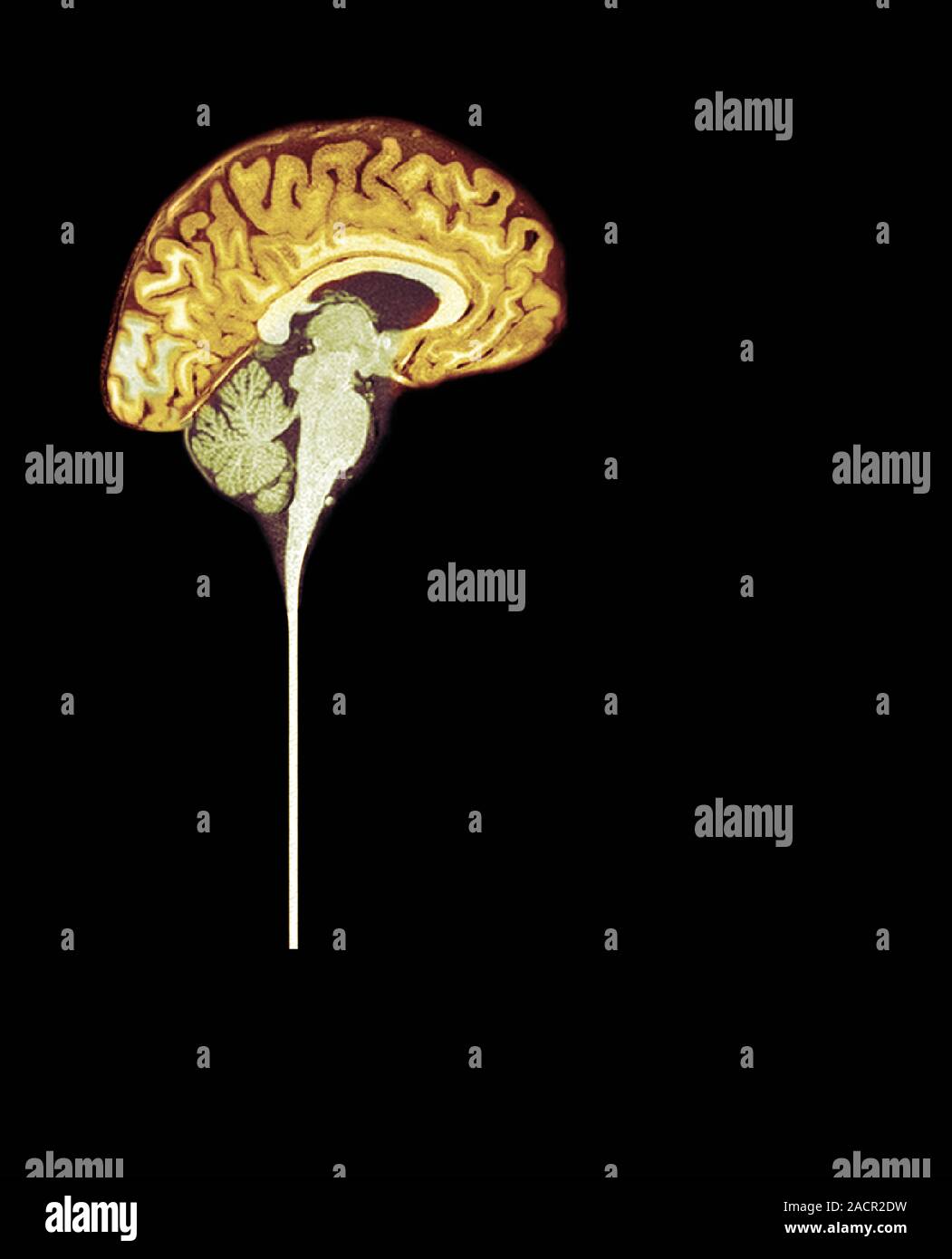 Brain. Coloured magnetic resonance imaging (MRI) scan of a sagittal section through a healthy ...