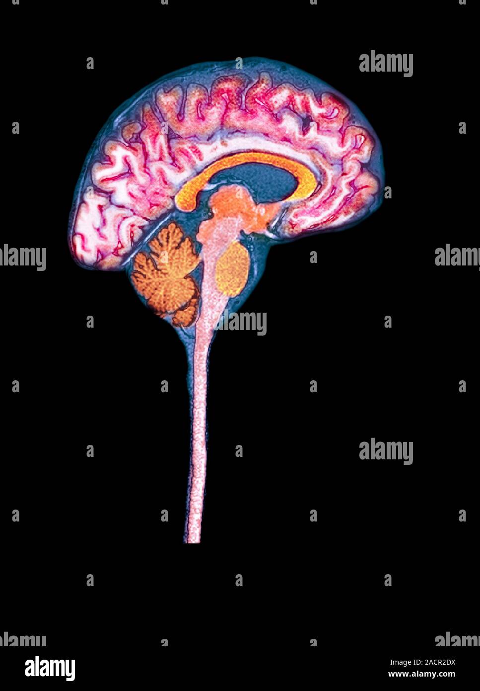 Brain. Coloured magnetic resonance imaging (MRI) scan of a sagittal section through a healthy ...