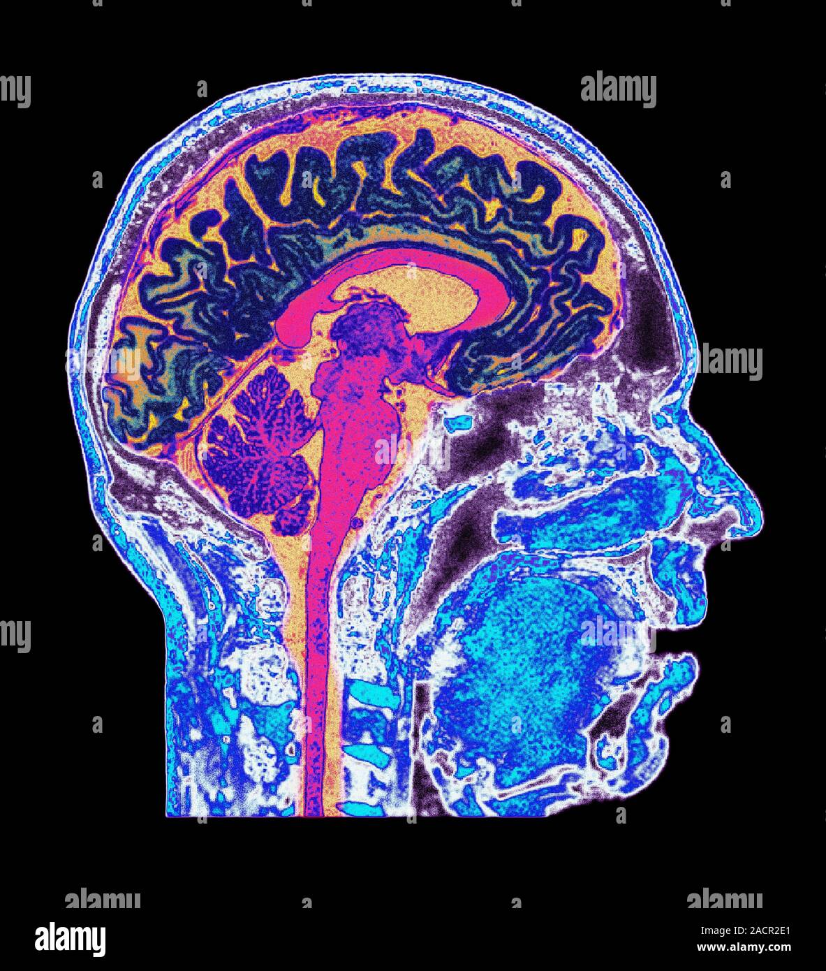 Brain. Coloured magnetic resonance imaging (MRI) scan of a sagittal section through a patient's ...