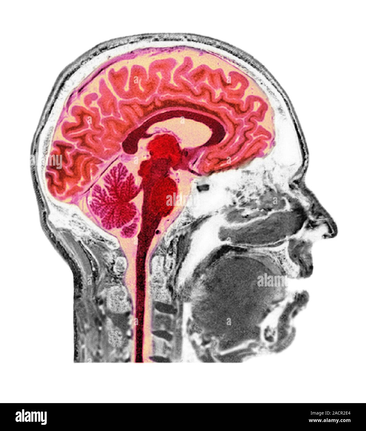 Brain. Coloured magnetic resonance imaging (MRI) scan of a sagittal section through a patient's ...
