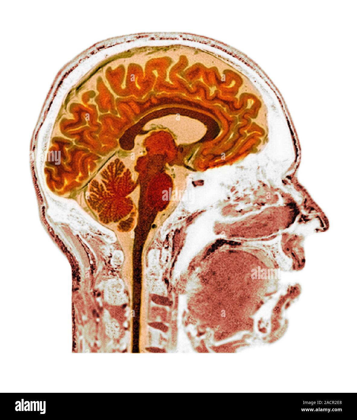 Brain. Coloured magnetic resonance imaging (MRI) scan of a sagittal section through a patient's ...