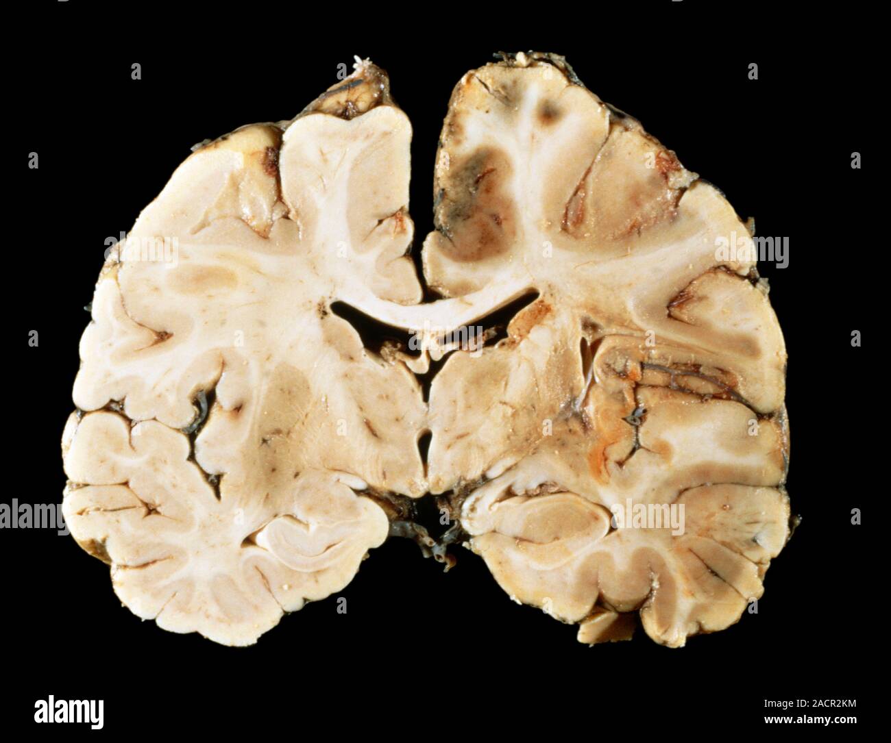 Brain injury. Gross specimen of a section through a brain showing ...