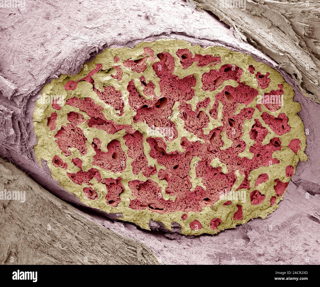 Broken finger bone. Coloured scanning electron micrograph (SEM) showing ...