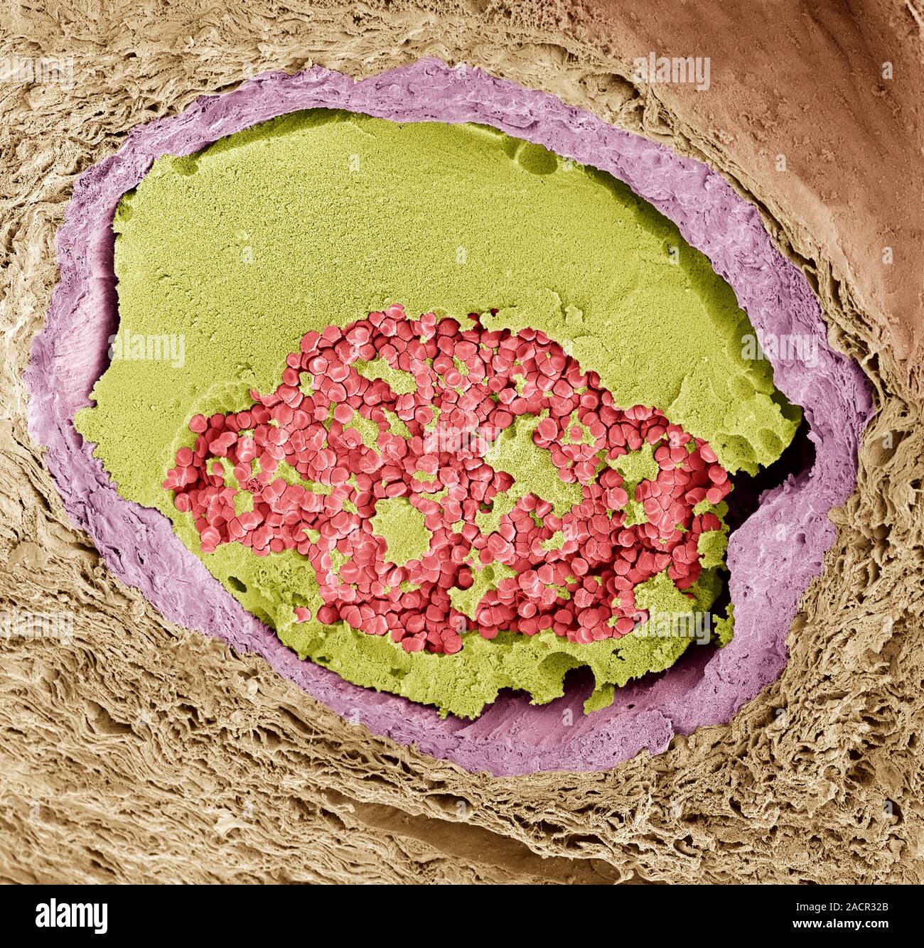 Blood clot. Coloured scanning electron micrograph (SEM) of a section ...
