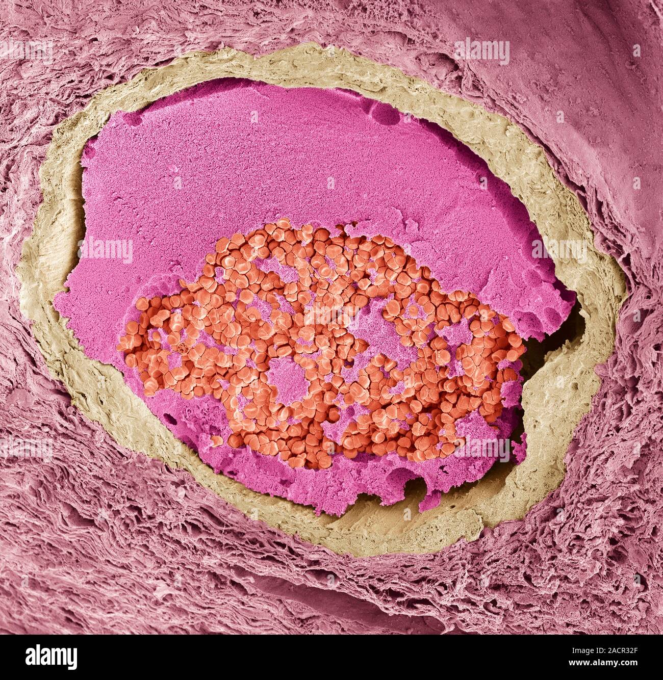 Blood clot. Coloured scanning electron micrograph (SEM) of a section ...