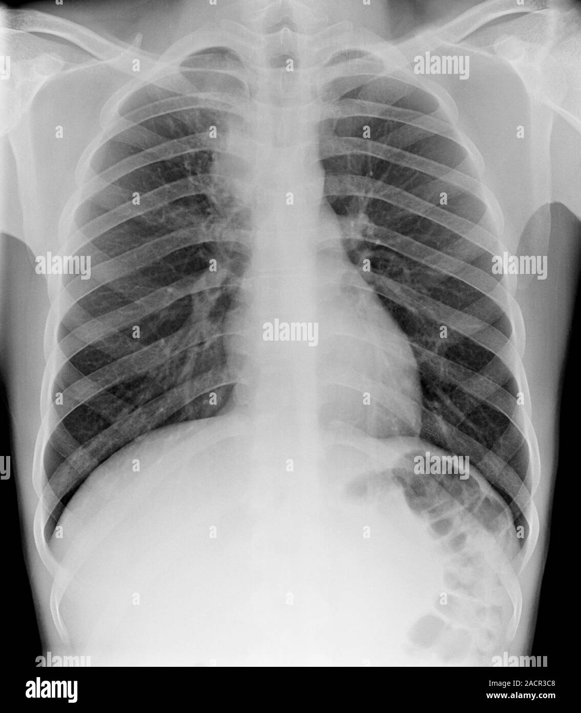 Tuberculosis. X-ray of the chest of a 25 year old male patient with ...
